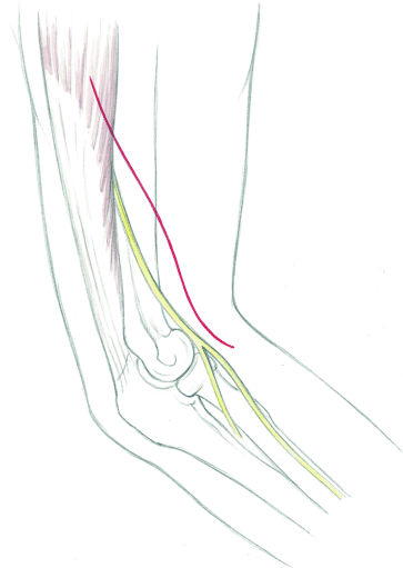 Kompressionssyndrome des N. radialis | SpringerLink