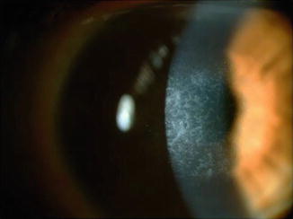 Other Complications: Haze-Related Myopic Shift After PRK on a LASIK ...