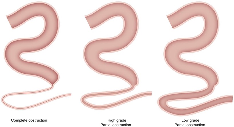 Small Bowel Obstruction | SpringerLink
