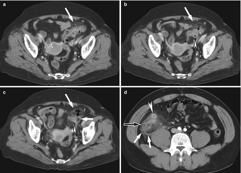 Inflammatory and Infectious Disease of the Colon | SpringerLink