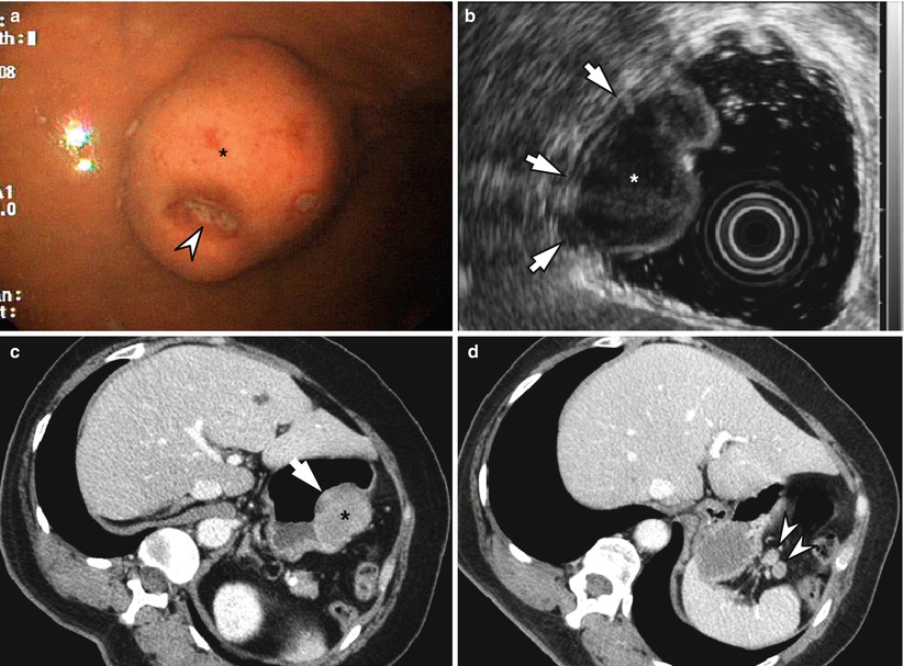 Subepithelial Lesions of the Stomach | SpringerLink
