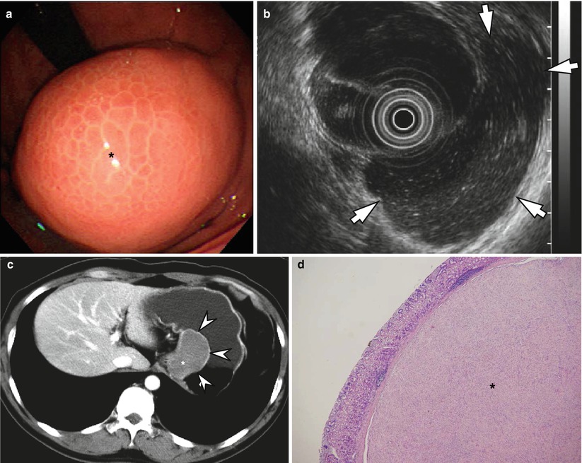 Subepithelial Lesions of the Stomach | SpringerLink