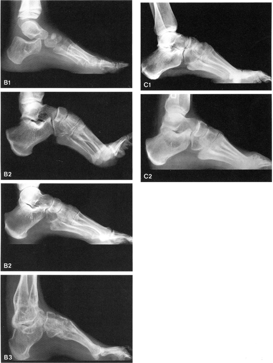 Pes Cavus | SpringerLink