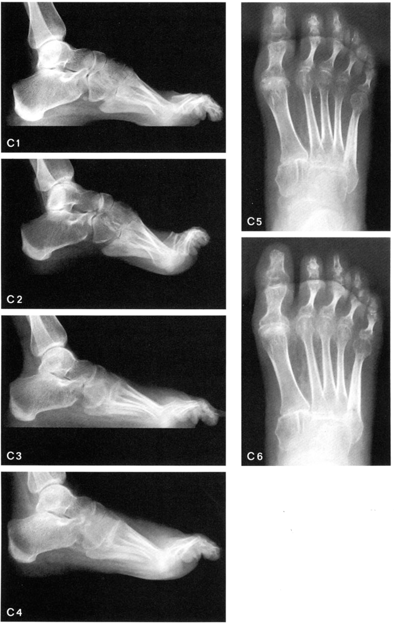 Pes Cavus | SpringerLink