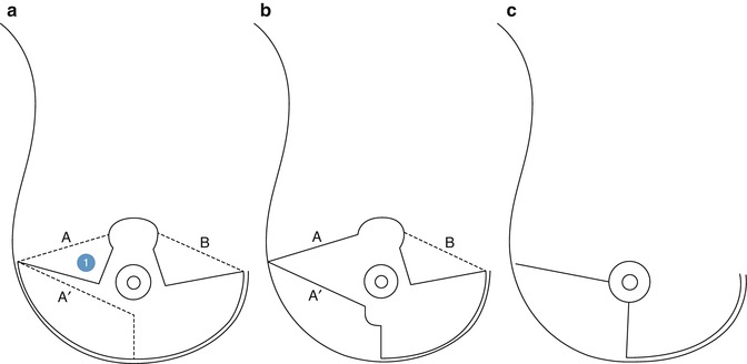Modification of the Wise Pattern Breast Reduction for Therapeutic ...