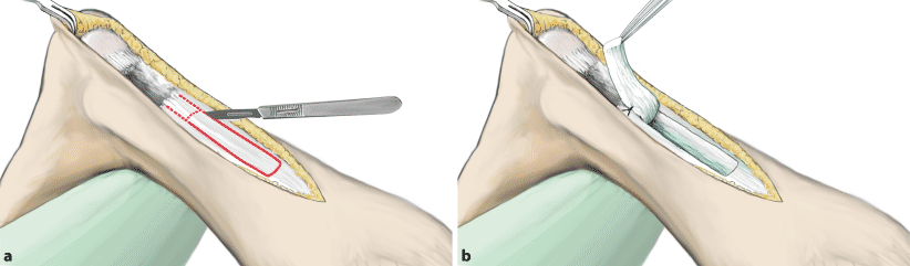 Achilles Tendon | SpringerLink