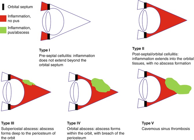 Infections of the Orbit | SpringerLink