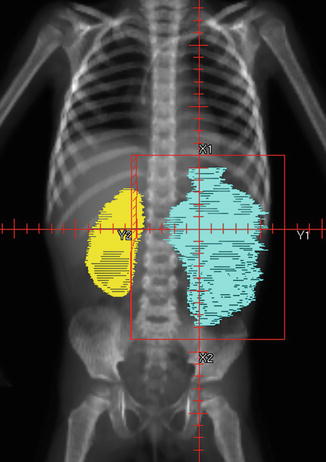 Radiotherapy for Wilms’ Tumour and Other Childhood Renal Cancers ...