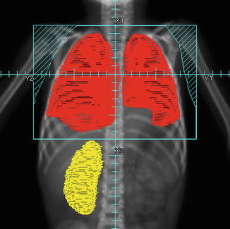 Radiotherapy for Wilms’ Tumour and Other Childhood Renal Cancers ...