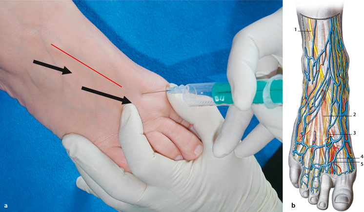 Injektionstechniken für den Fuß | SpringerLink