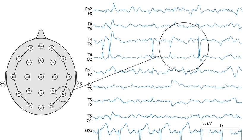 Elektroenzephalografie (EEG) | SpringerLink