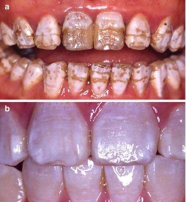 Enamel Defects in the Permanent Dentition: Prevalence and Etiology ...