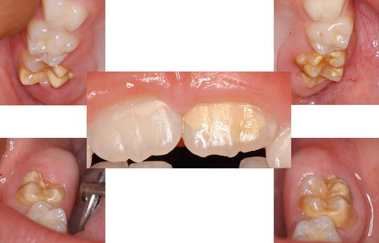 Molar Incisor Hypomineralization and Hypomineralized Second Primary ...