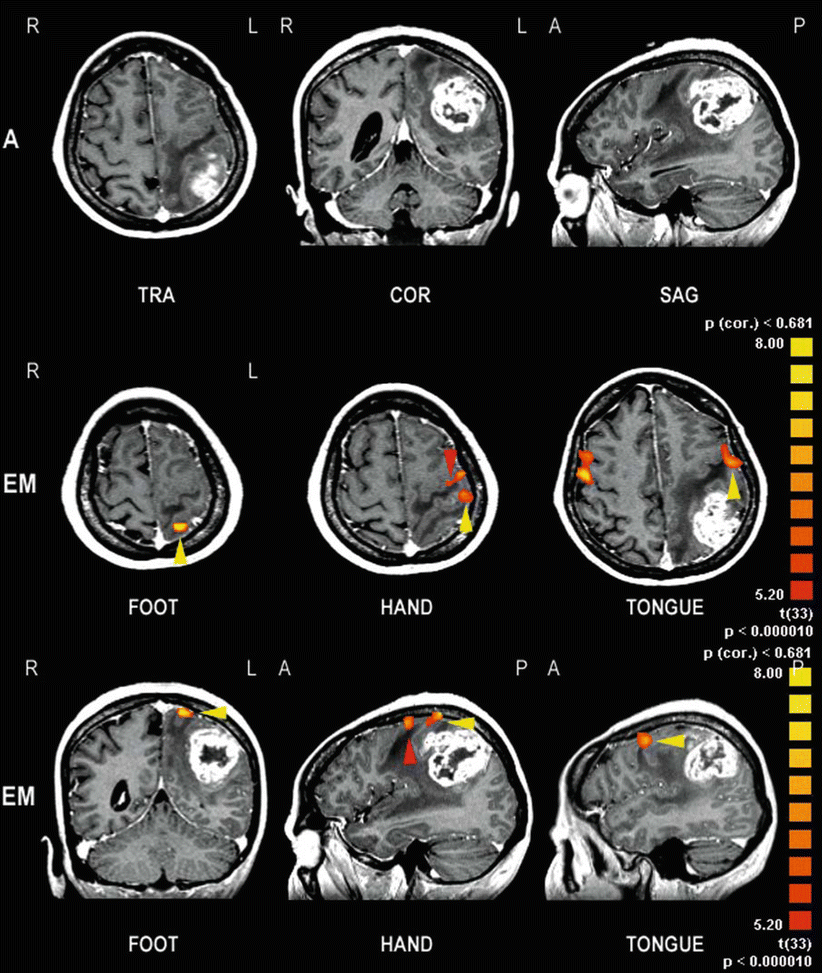 Task-Based Presurgical Functional MRI in Patients with Brain Tumors ...