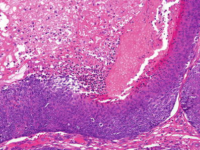Adnextumoren mit Talgdrüsen- und Haarfollikeldifferenzierung | SpringerLink