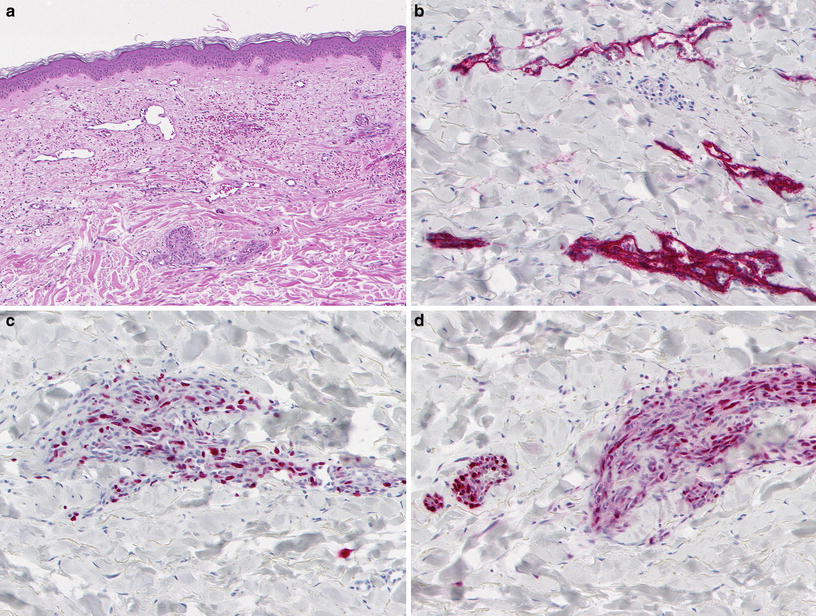 Gefäßtumoren der Haut | SpringerLink