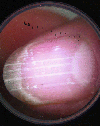 Hailey-Hailey Disease (Familial Benign Pemphigus) | SpringerLink