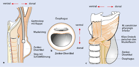 Endoskopische Rekanalisationsverfahren | SpringerLink