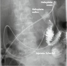 Endoskopische Ernährungstechniken | SpringerLink