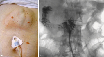 Endoskopische Ernährungstechniken | SpringerLink