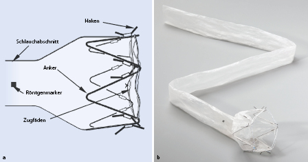 Endoskopische Ernährungstechniken | SpringerLink