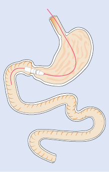 Endoskopische Ernährungstechniken | SpringerLink