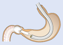Endoskopische Ernährungstechniken | SpringerLink