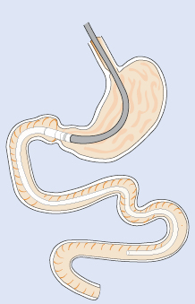 Endoskopische Ernährungstechniken | SpringerLink