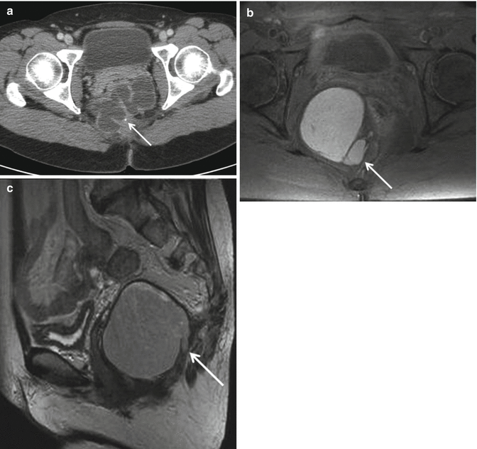 Retroperitoneal Tumors | SpringerLink