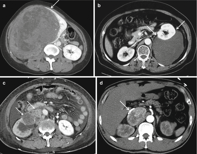 Retroperitoneal Tumors | SpringerLink