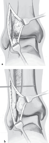 Distale anatomische Syndesmosenplastik | SpringerLink