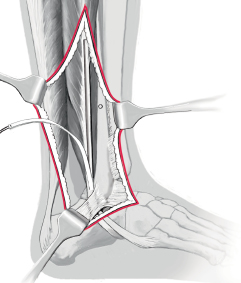 Distale anatomische Syndesmosenplastik | SpringerLink