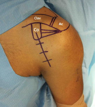 Anterior Surgical Approaches to the Shoulder | SpringerLink