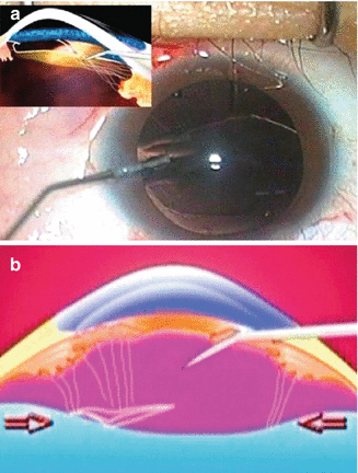 Dislocation of Crystalline Lens and Marfan’s Syndrome | SpringerLink