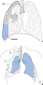 Thoraxtrauma | SpringerLink