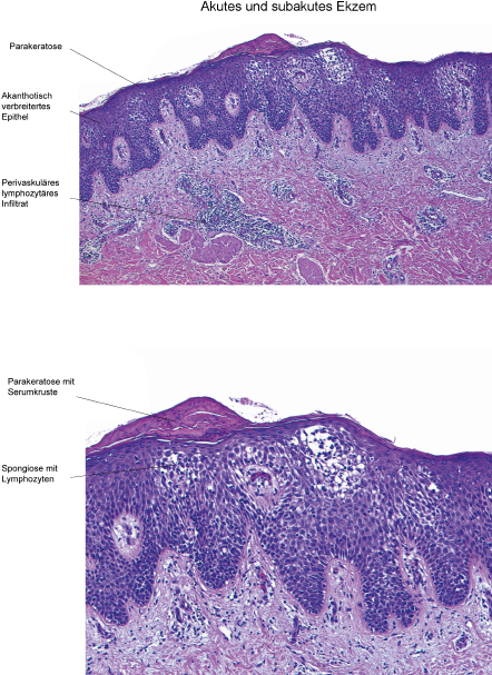 Epidermis – Spongiose, Akanthose und Hyperparakeratose | SpringerLink