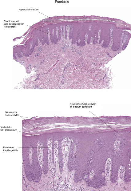 Epidermis – Spongiose, Akanthose und Hyperparakeratose | SpringerLink