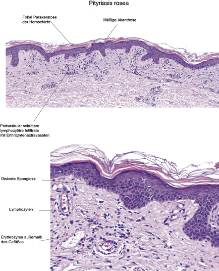 Epidermis – Spongiose, Akanthose und Hyperparakeratose | SpringerLink