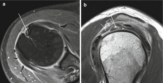Shoulder Imaging | SpringerLink