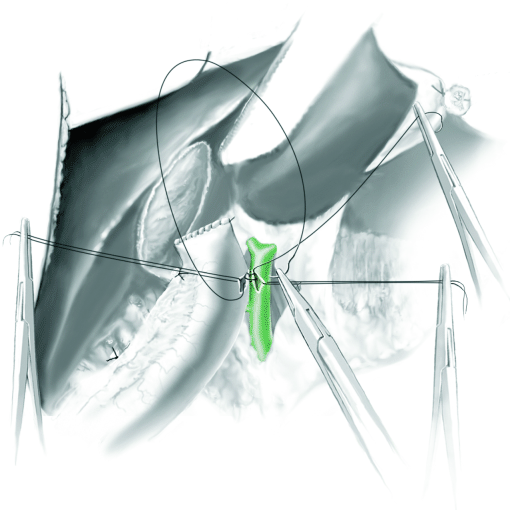 Choledochojejunostomy and Cholecystojejunostomy | SpringerLink