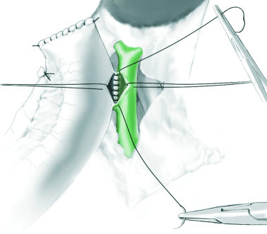 Choledochojejunostomy and Cholecystojejunostomy | SpringerLink