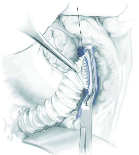 Mesocaval Shunt | SpringerLink
