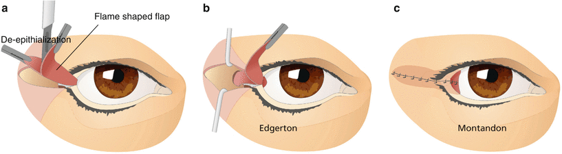 Lateral Canthal Surgery in Blepharoplasty | SpringerLink