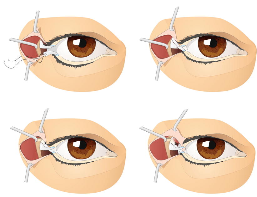 Lateral Canthal Surgery in Blepharoplasty | SpringerLink