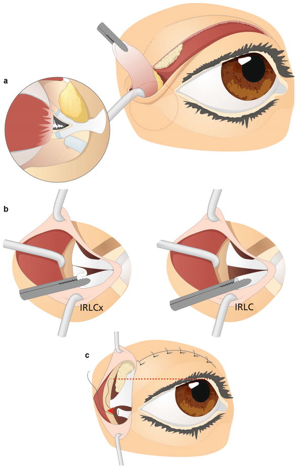 Lateral Canthal Surgery in Blepharoplasty | SpringerLink