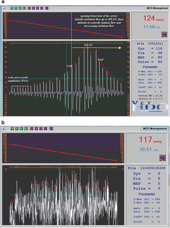 High Definition Oscillometry: Non-invasive Blood Pressure Measurement ...