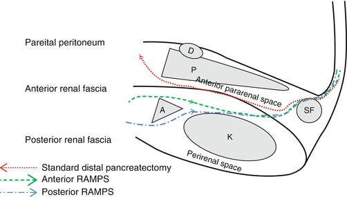Radical Antegrade Modular Pancreato-splenectomy (RAMPS) | SpringerLink