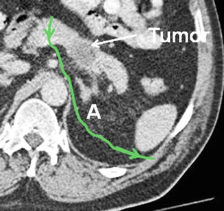 Radical Antegrade Modular Pancreato-splenectomy (RAMPS) | SpringerLink