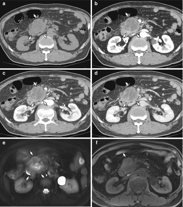 Imaging Diagnosis of Pancreatic Cancer: CT and MRI | SpringerLink