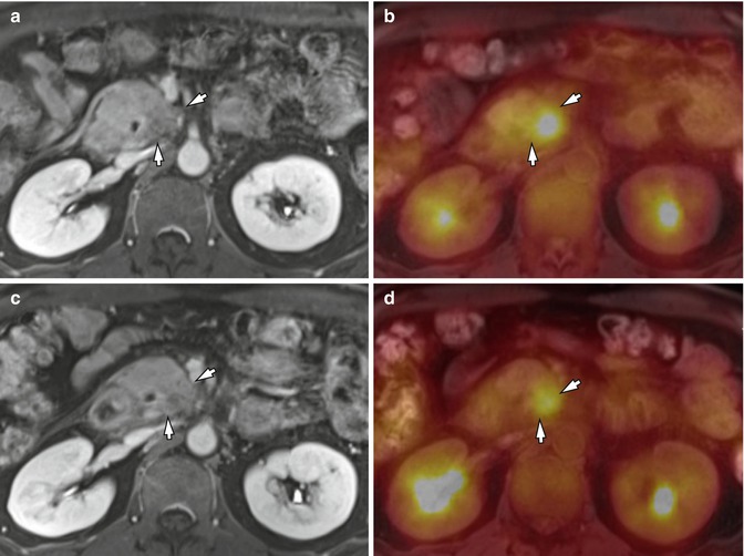 Imaging Diagnosis of Pancreatic Cancer: CT and MRI | SpringerLink
